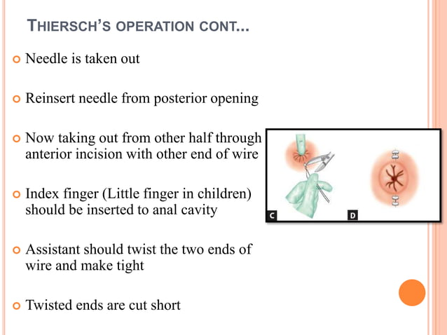 Dr Anisha Rectal prolapse.pptx