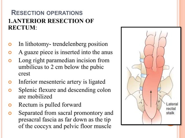Dr Anisha Rectal prolapse.pptx