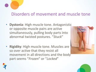Dr. Anne Stratton: Movement Disorders in the Rett Clinic Population | PPT
