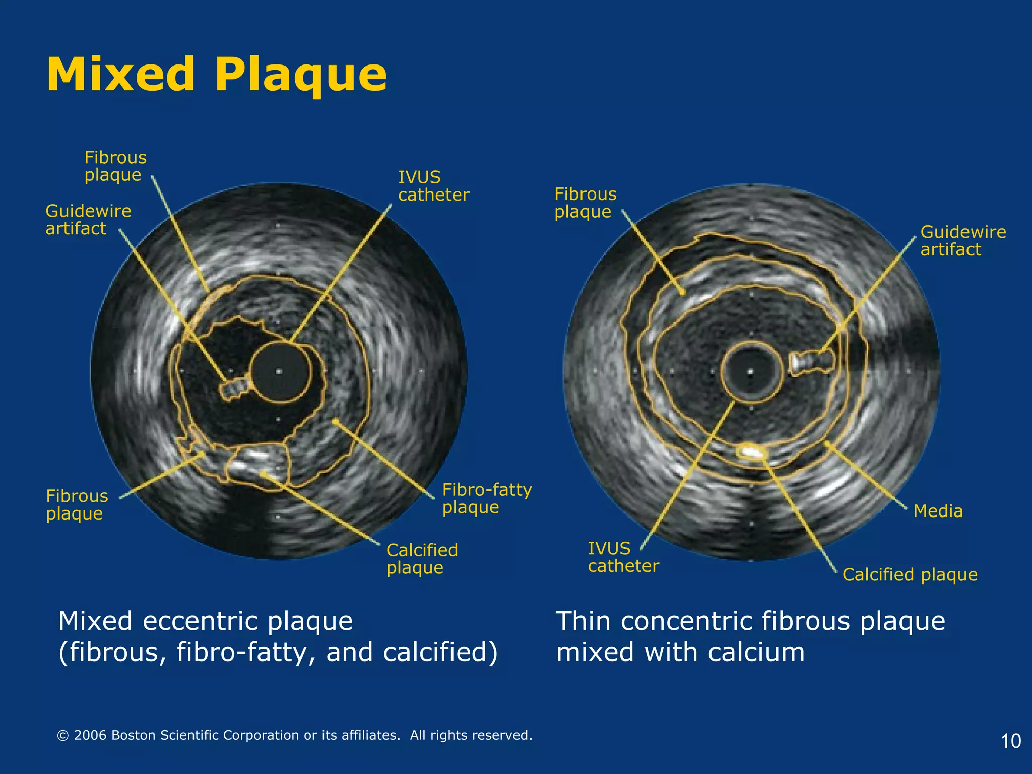 IVUS Image Interpretation and Analysis | PPT
