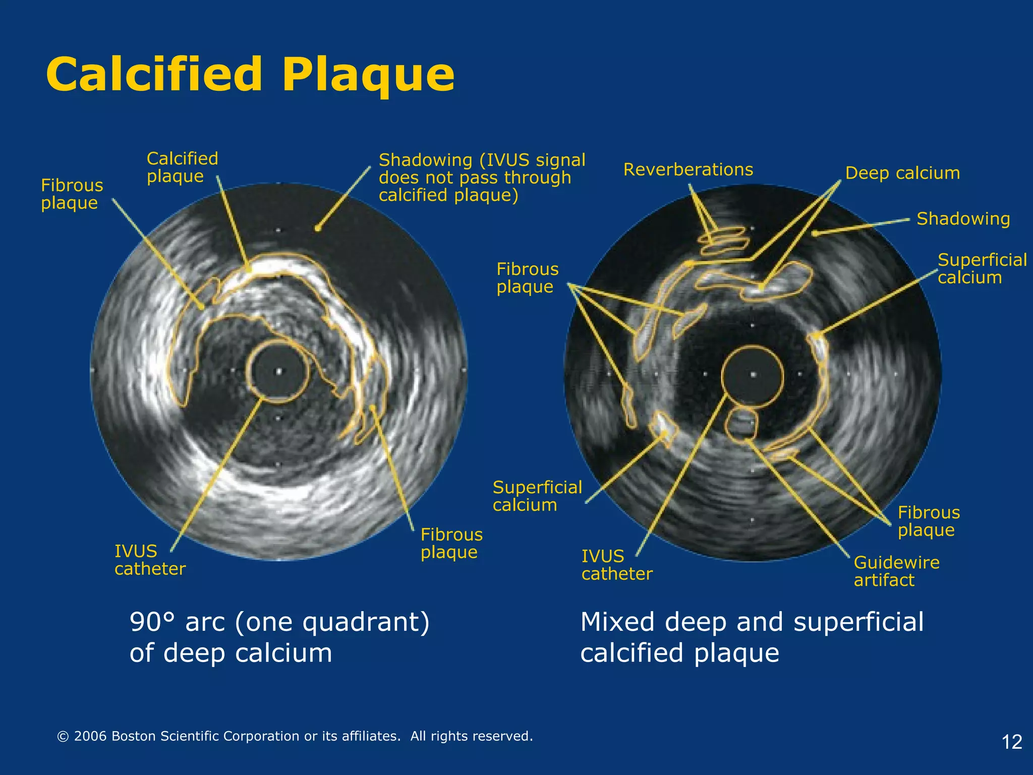 IVUS Image Interpretation and Analysis | PPT