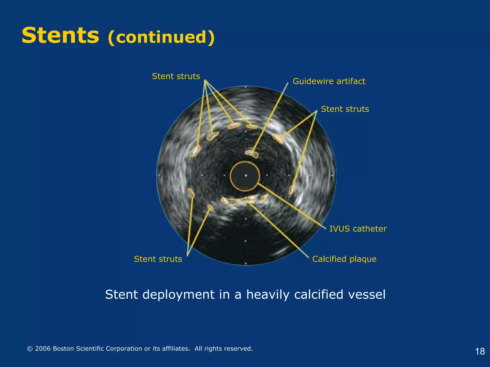 IVUS Image Interpretation and Analysis | PPT | Heart and Cardiovascular ...