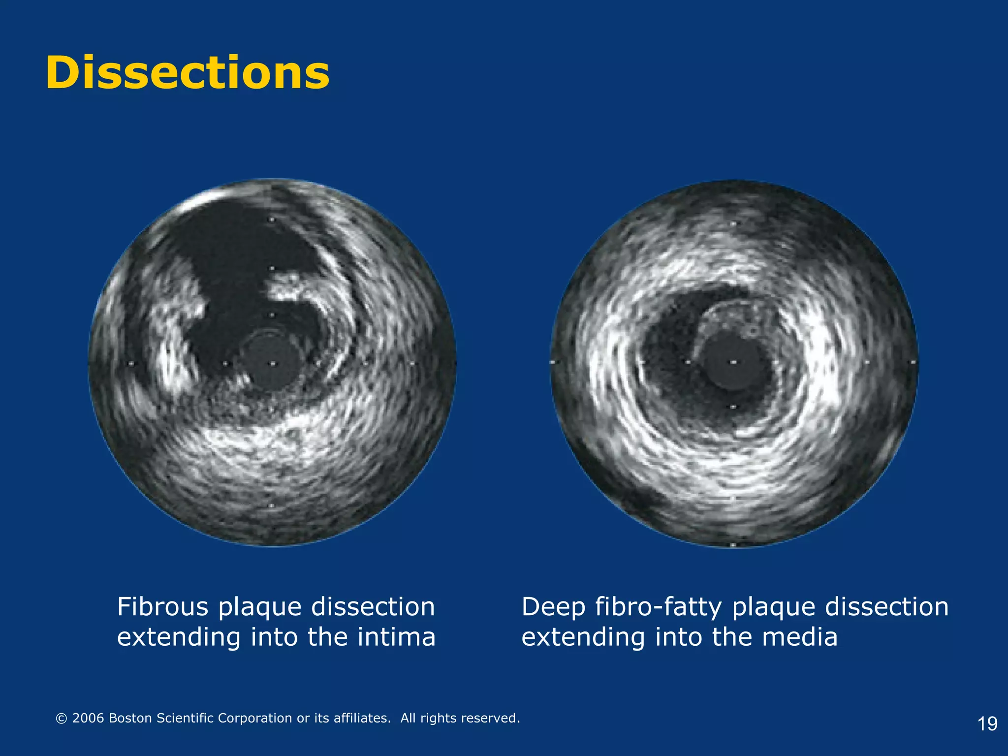 IVUS Image Interpretation and Analysis | PPT