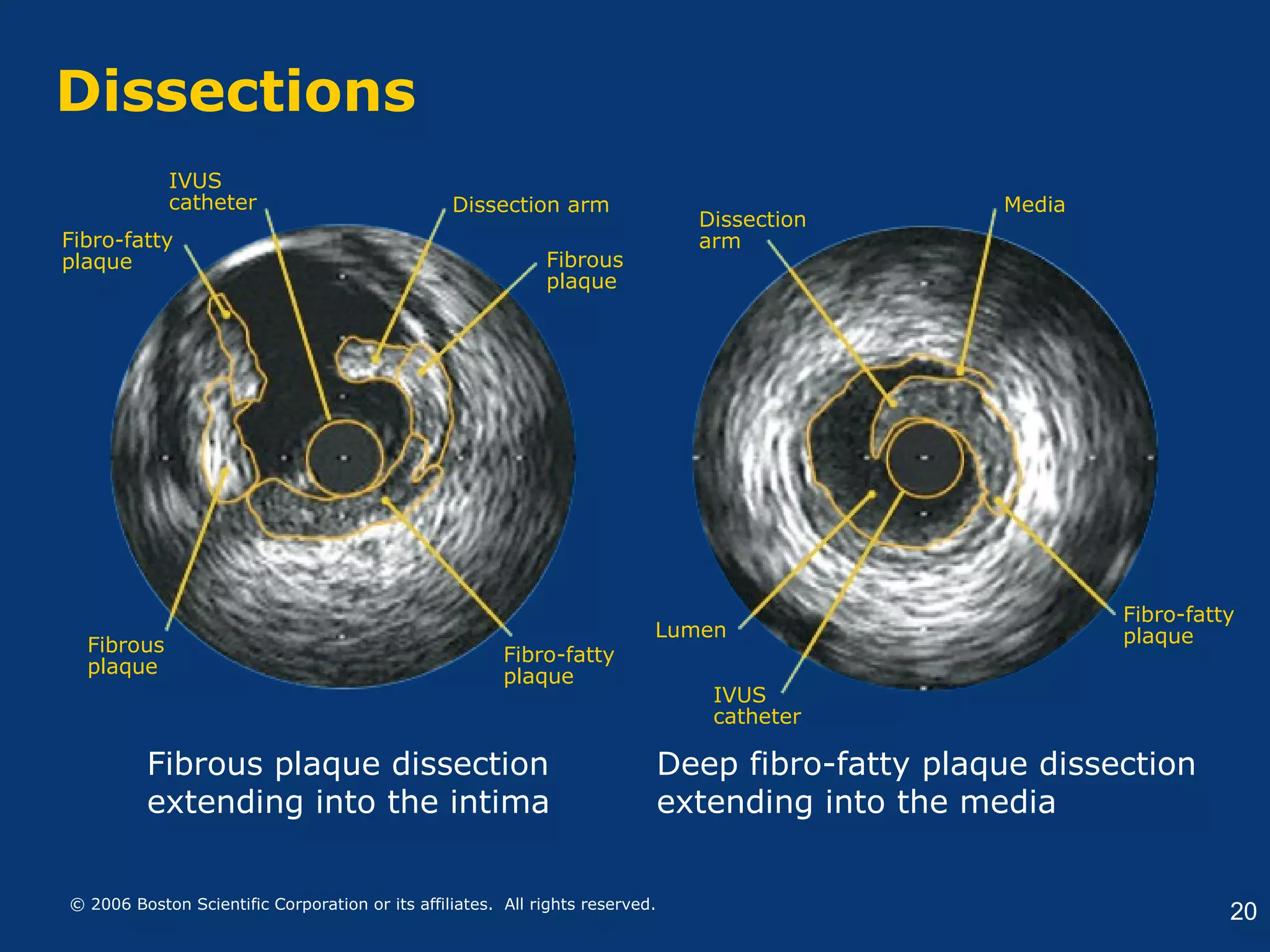 IVUS Image Interpretation and Analysis | PPT