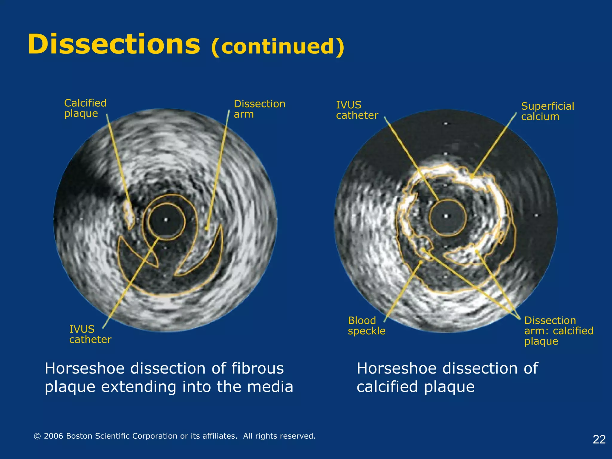 IVUS Image Interpretation and Analysis | PPT
