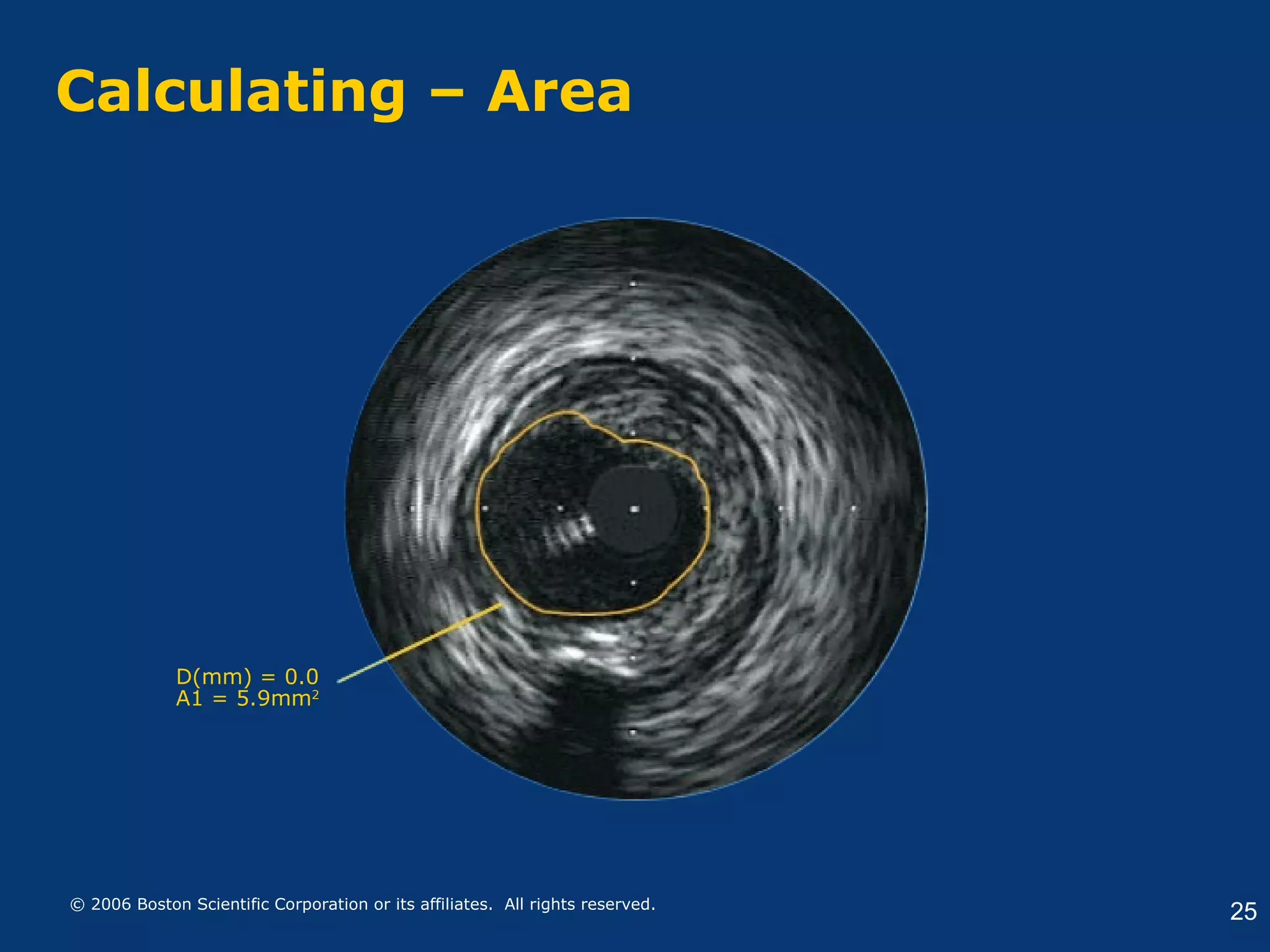 IVUS Image Interpretation and Analysis | PPT