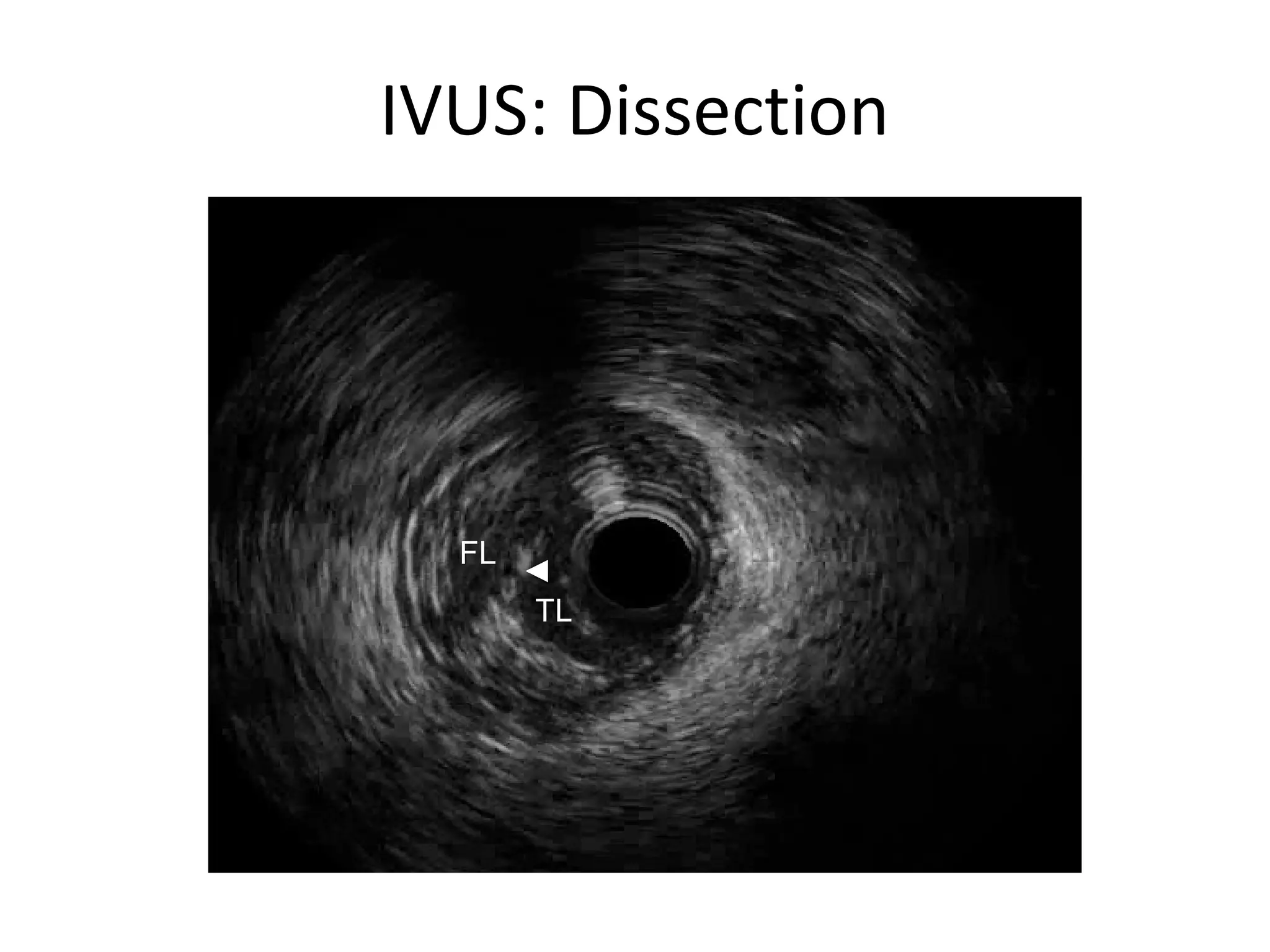 IVUS Image Interpretation and Analysis | PPT