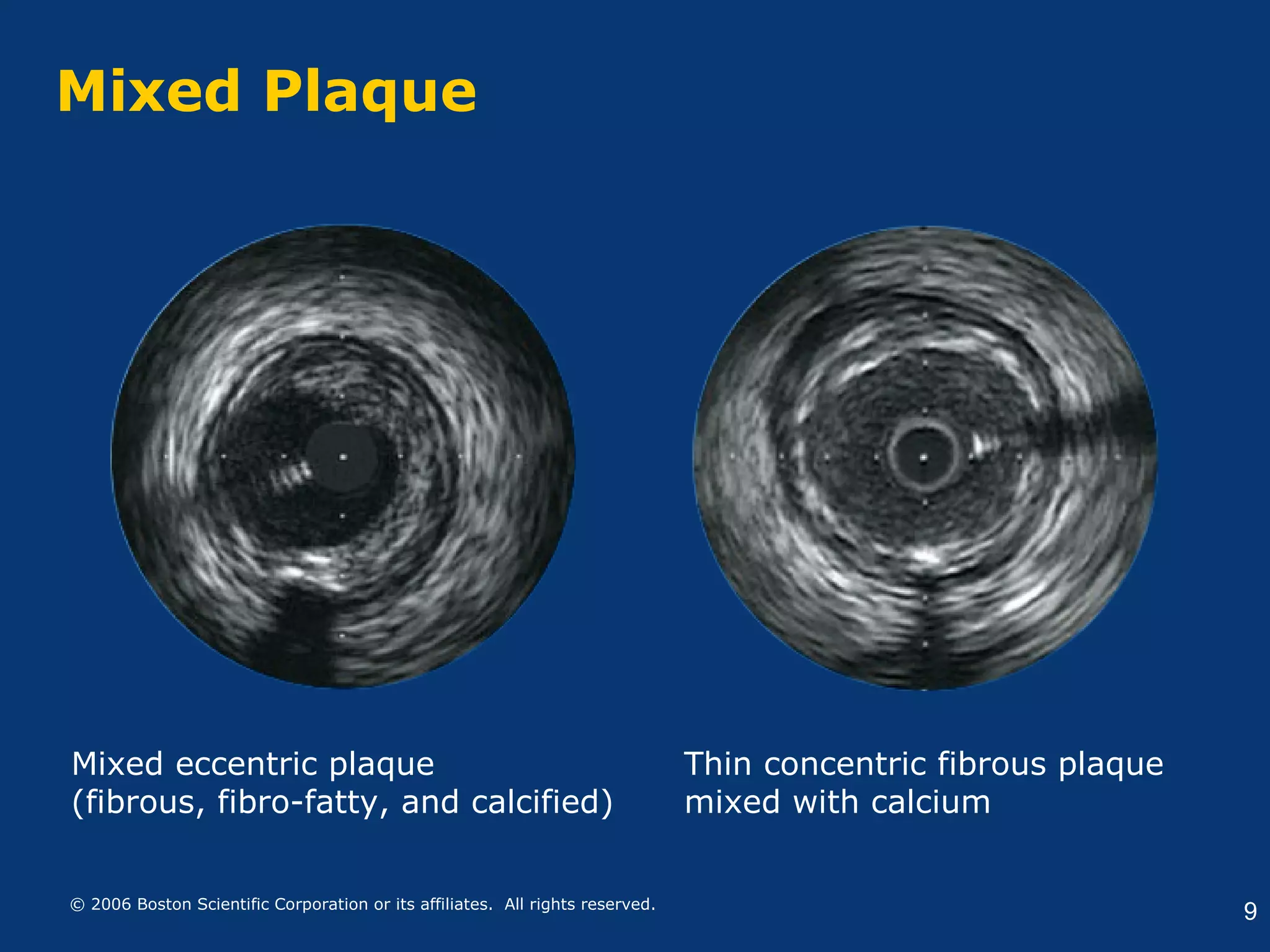 IVUS Image Interpretation and Analysis | PPT