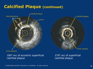 IVUS Image Interpretation and Analysis | PPT
