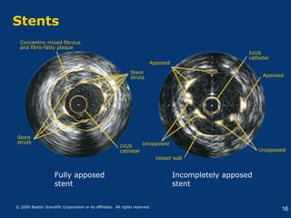 IVUS Image Interpretation and Analysis | PPT