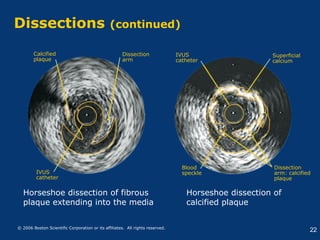 IVUS Image Interpretation and Analysis | PPT