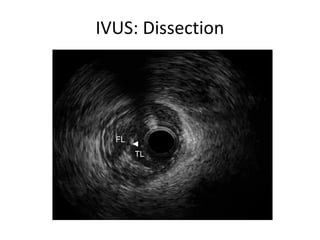 IVUS Image Interpretation and Analysis | PPT
