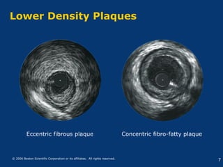 IVUS Image Interpretation and Analysis | PPT