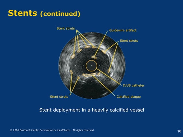 IVUS Image Interpretation and Analysis | PPT