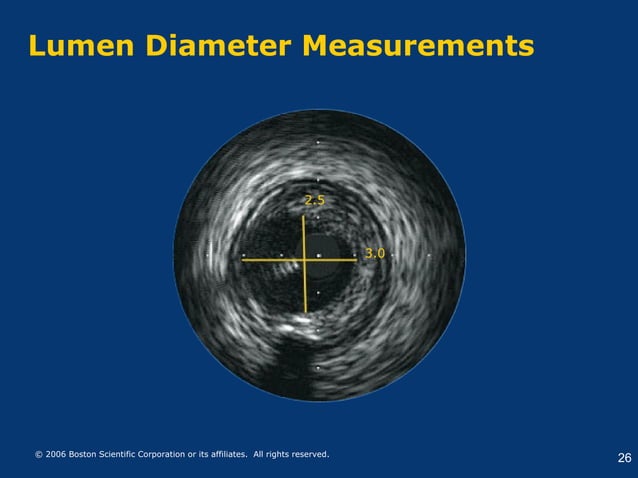 IVUS Image Interpretation and Analysis | PPT