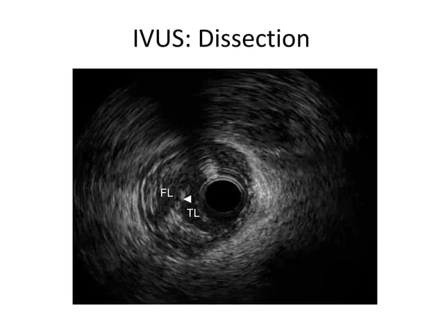 IVUS Image Interpretation and Analysis | PPT