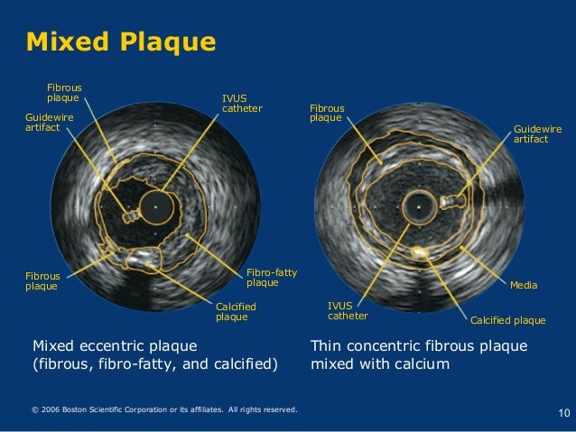 IVUS Image Interpretation and Analysis