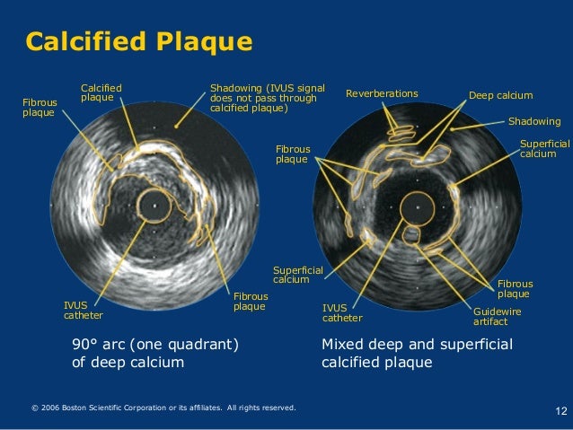 IVUS Image Interpretation and Analysis