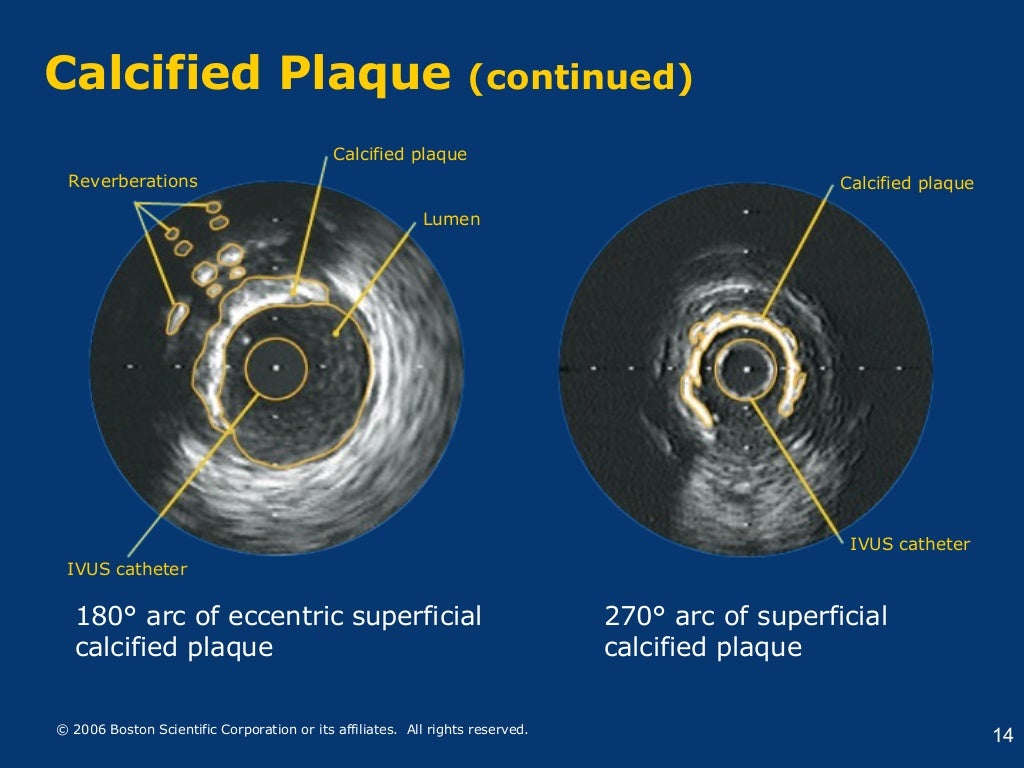 IVUS Image Interpretation and Analysis