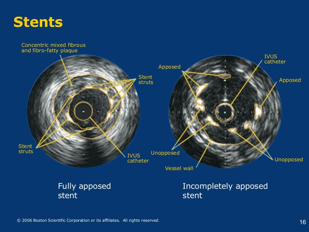 IVUS Image Interpretation and Analysis