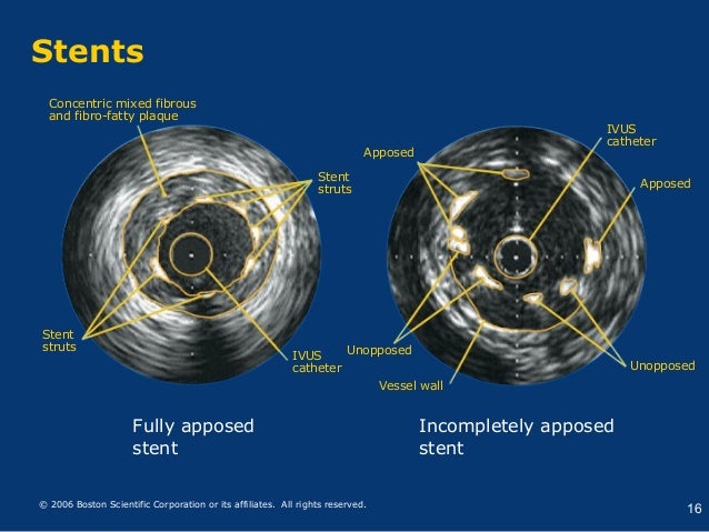 IVUS Image Interpretation and Analysis