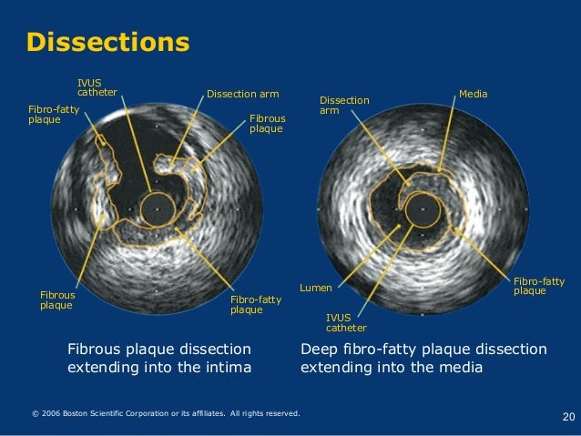 IVUS Image Interpretation and Analysis