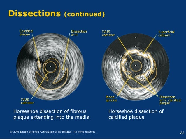 IVUS Image Interpretation and Analysis