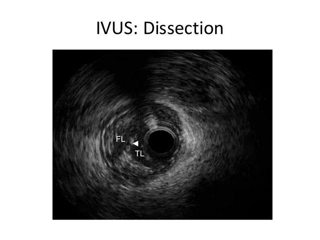 IVUS Image Interpretation and Analysis