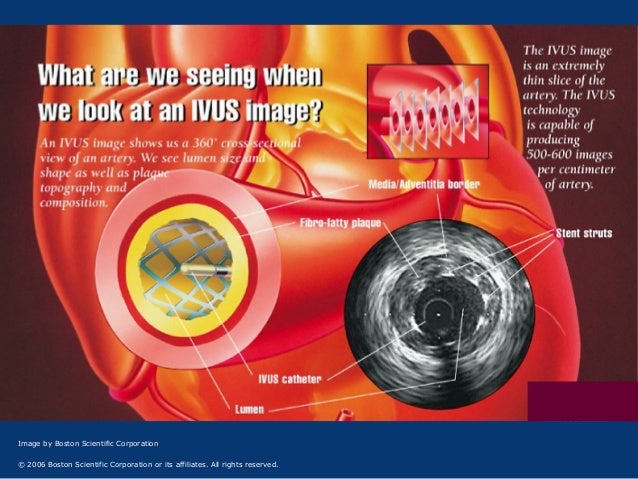 IVUS Image Interpretation and Analysis