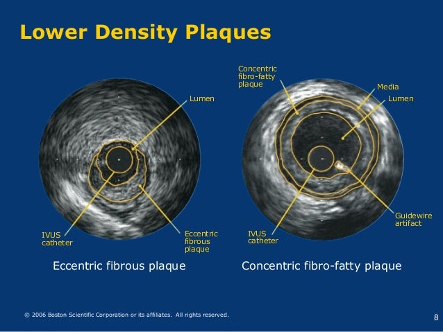 IVUS Image Interpretation and Analysis