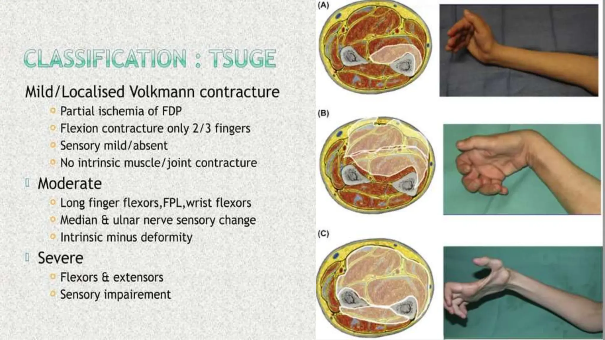 volkmann ischemic contracture orthopaedics.pptx