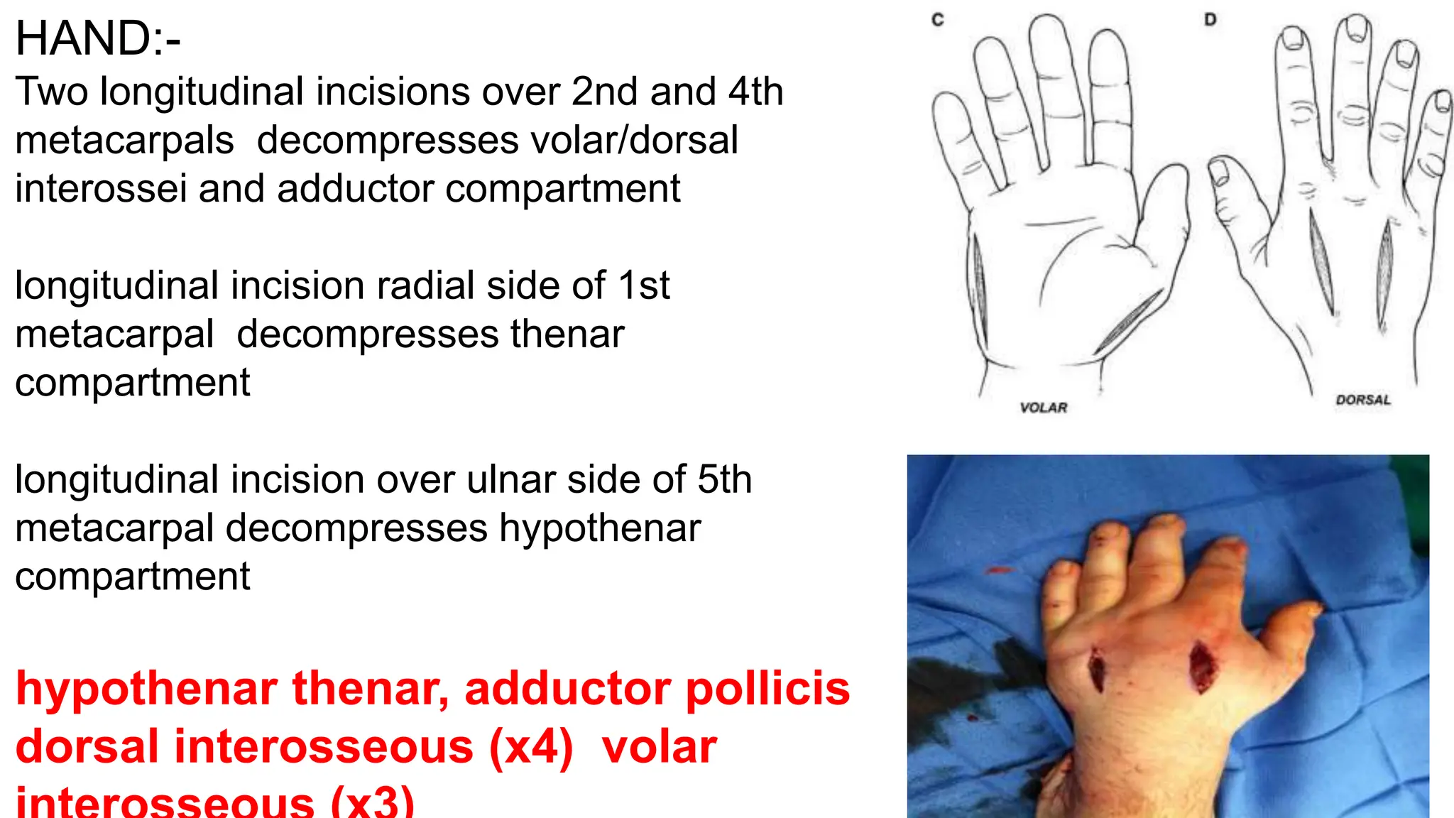 volkmann ischemic contracture orthopaedics.pptx