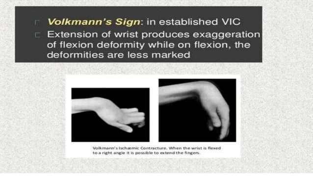 volkmann ischemic contracture orthopaedics.pptx | First Aid | Injuries