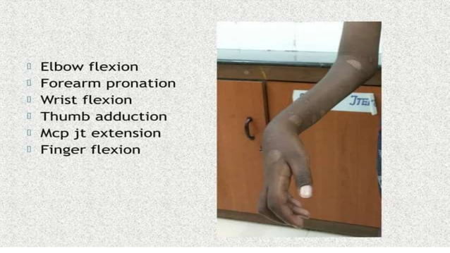 volkmann ischemic contracture orthopaedics.pptx | First Aid | Injuries