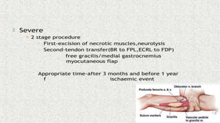volkmann ischemic contracture orthopaedics.pptx