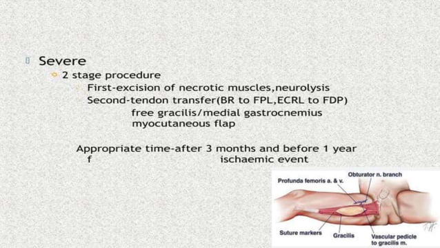 volkmann ischemic contracture orthopaedics.pptx | First Aid | Injuries
