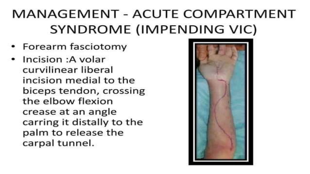 volkmann ischemic contracture orthopaedics.pptx | First Aid | Injuries