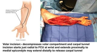 volkmann ischemic contracture orthopaedics.pptx