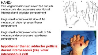 volkmann ischemic contracture orthopaedics.pptx