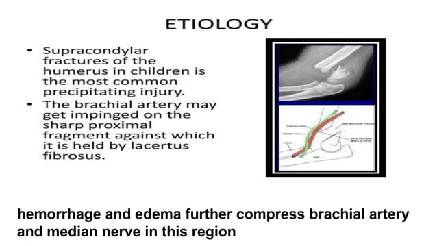 volkmann ischemic contracture orthopaedics.pptx | First Aid | Injuries