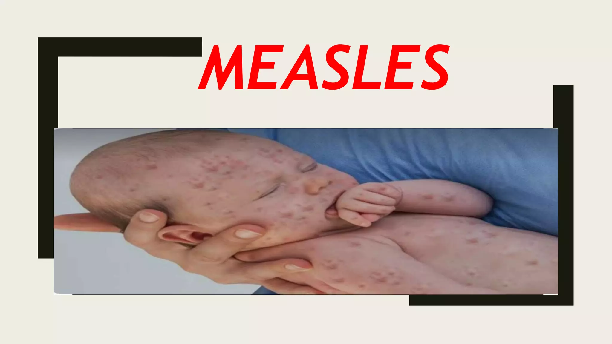measles.pptx