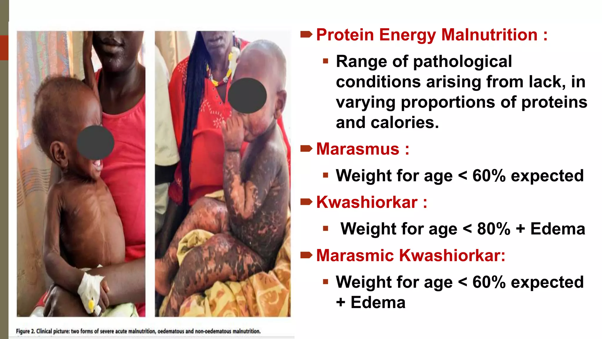 Severe Acute Malnutrition (SAM) and Nutrition Rehabilitation Centre ...