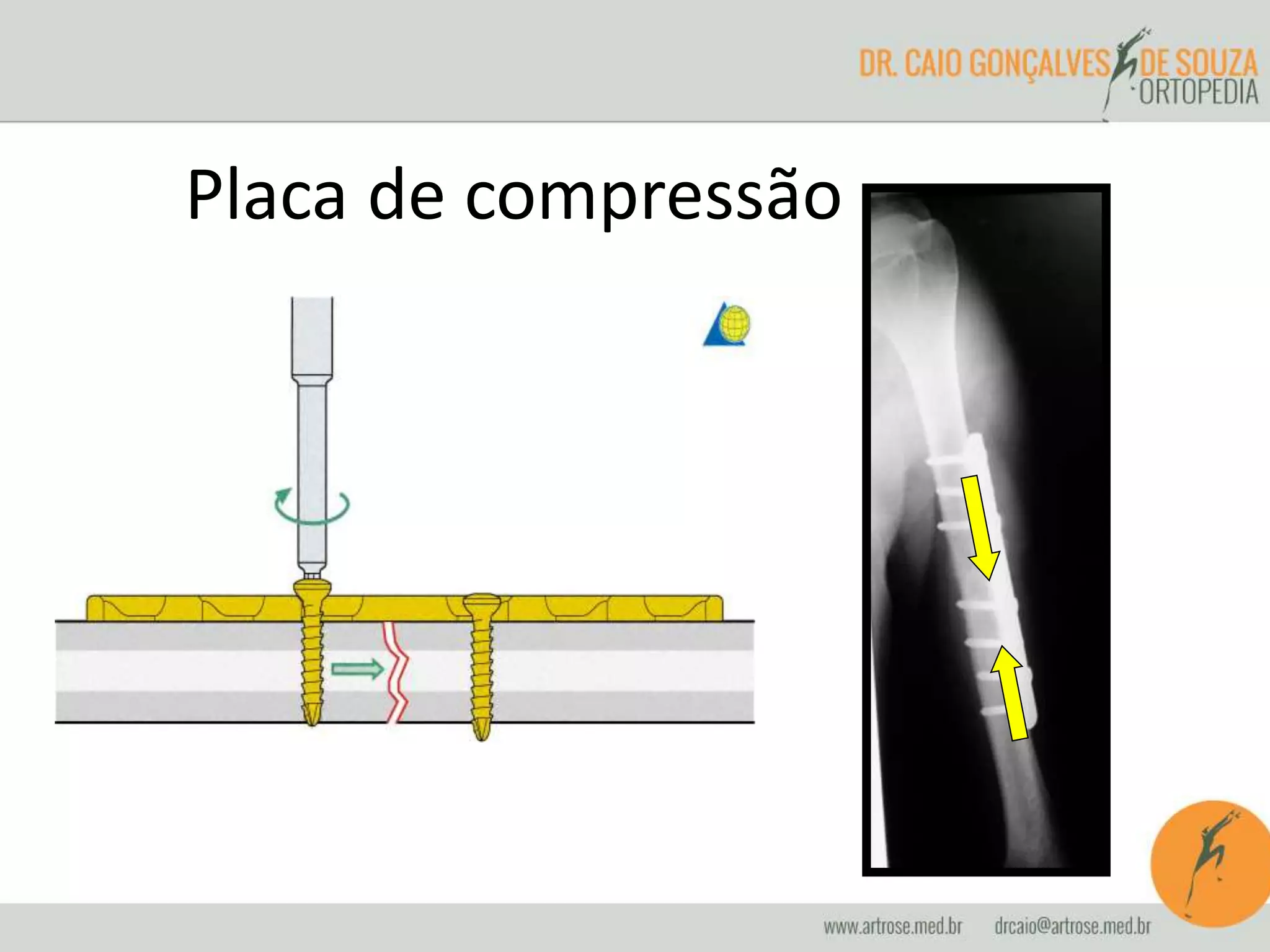 Princípios De Consolidação E Tratamento Das Fraturas Ppt