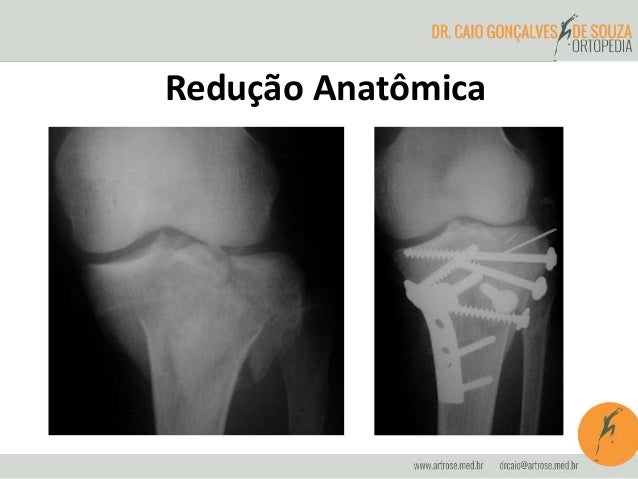 Princípios De Consolidação E Tratamento Das Fraturas