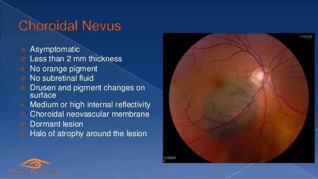 Ocular Melanoma Basics