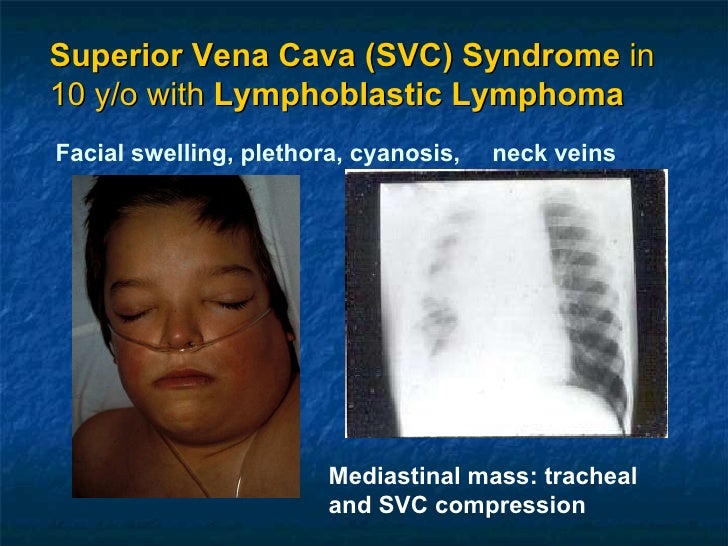 Dr Ciro Liberato - Epidemiologia Cancer Infantil