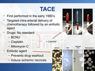 Local Therapies for Uveal Melanoma Liver Metastases | PPT | Cancer ...