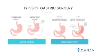 Dr Dato Anitha Haniffa - Understanding Bariatric Surgery.pdf