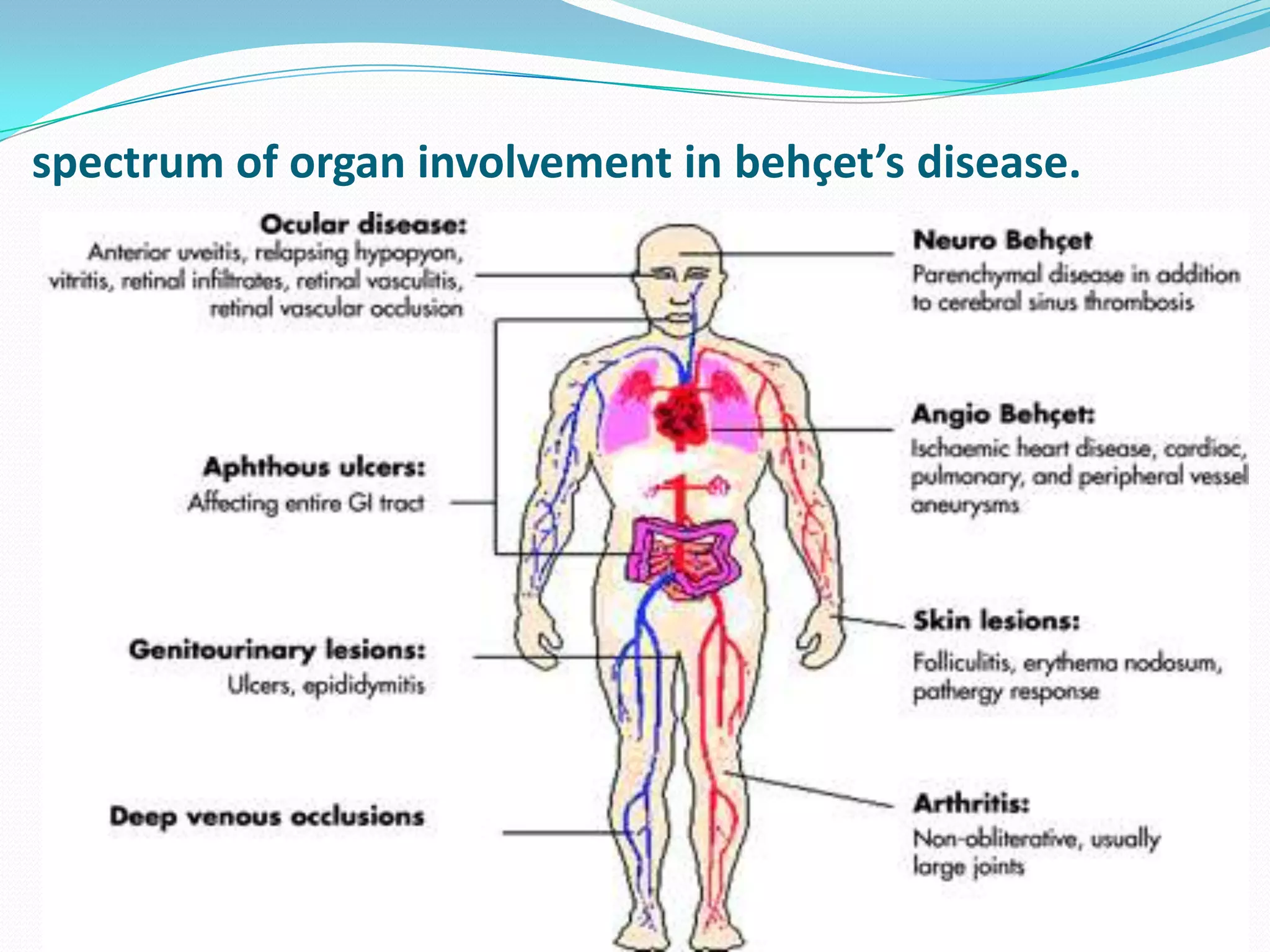 Behcet's disease | PPTX