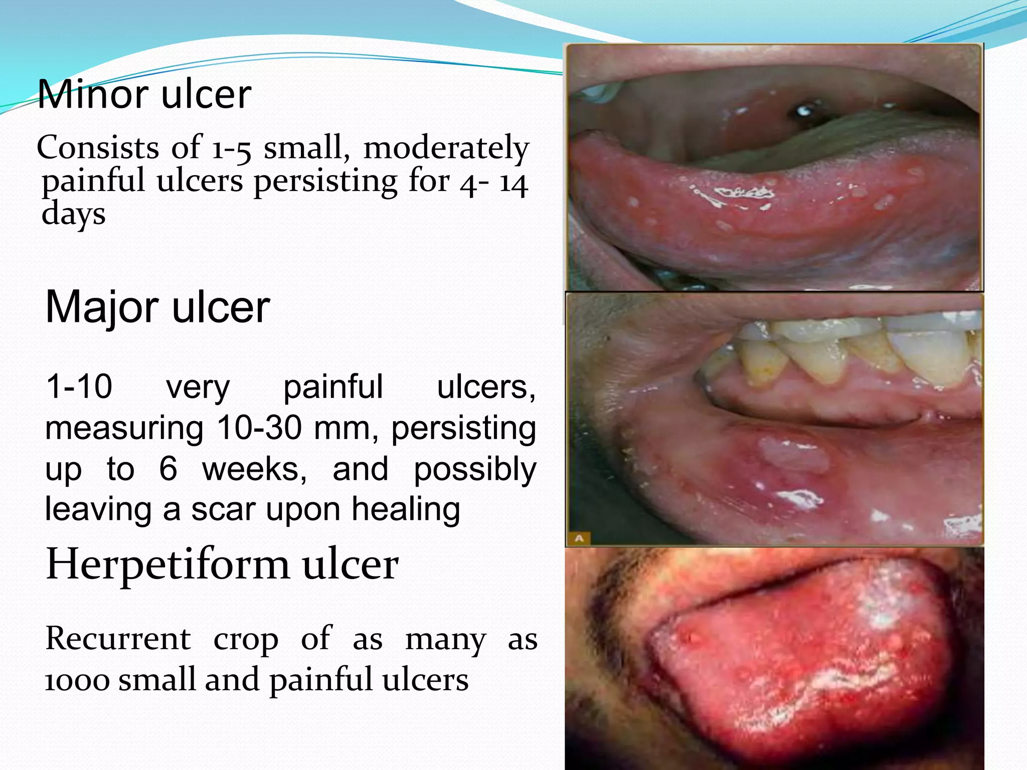 Behcet's disease | PPTX